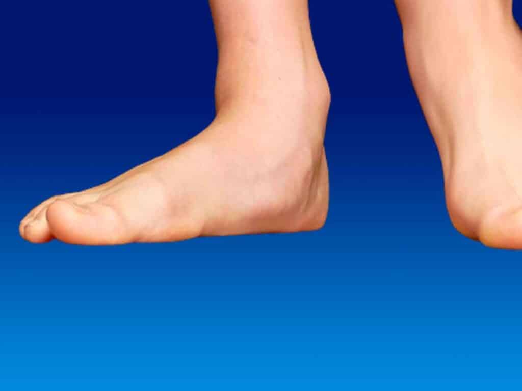 Tratamento para Pé Plano em Maringá PR - Dr. André Peretti